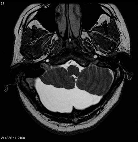 Арахноидальная киста задней черепной ямки ЗЧЯ симптомы и лечение