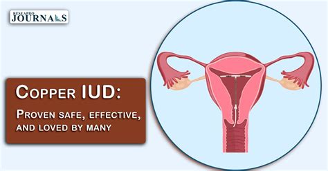 Copper Iud Proven Safe Effective And Loved By Many