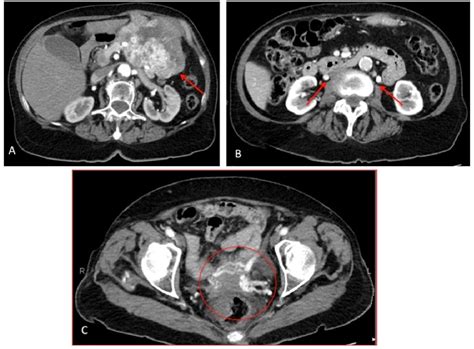 Figure 7 From Pelvic Congestion Syndrome Findings At Ct Angiography
