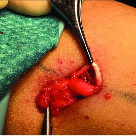 Intraoperative Find Of Migrated Contraceptive Implant Device Lying On