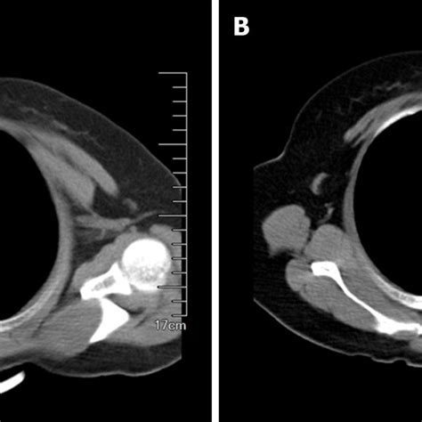 Computed Tomography Scan A Before Treatment The Enlarged Lymph Node