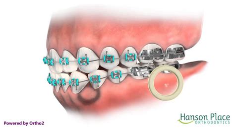 Class Iii Elastics For Braces In Brooklyn Ny Youtube