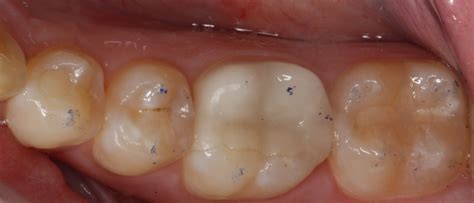 Check Your Occlusion Before You Prep 3d Dentists