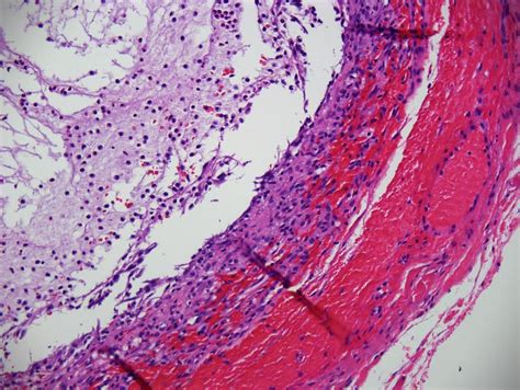 Mucocele Histology