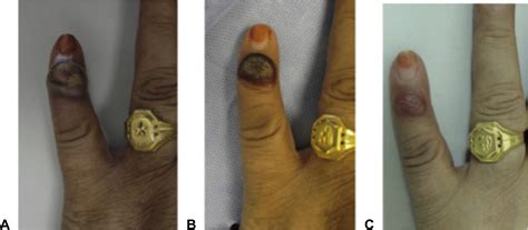 Hand Infections Journal Of Hand Surgery