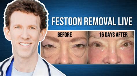 Festoon Under Eye Bags At Numbers Mcleod Blog
