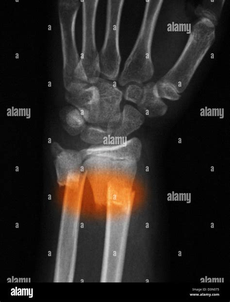 Broken Radius X Ray