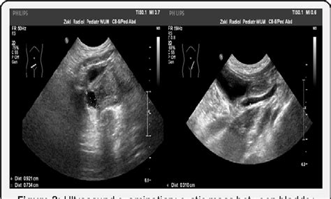 Figure 3 From Symptomatic Gartner Duct Cyst In A Newborn Diagnosis And Management Semantic