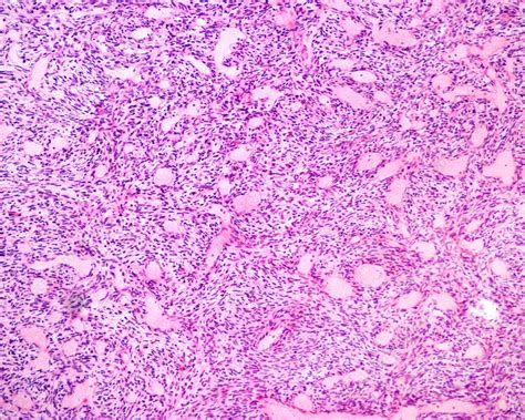 Fibrosarcoma Light Micrograph Stock Image C059 7598 Science Photo Library