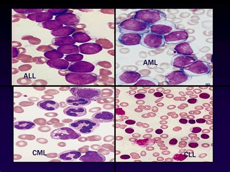 Chronic Leukaemias Heterogeneous Group Of Hematopoietic Neoplasms Ppt Download
