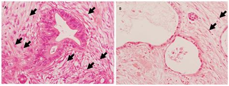Fibrous Pattern Of Pancreatic Cancer A Immature Fibrosis Contains An