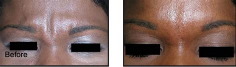Los Angeles Neurotox® Brow Lift Beverly Hills Eye Brow Lift Injections