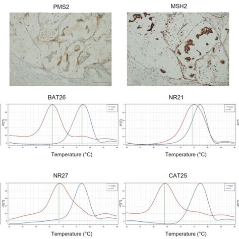 Representative Results Of Crc Case Showing Pammr Ihc And Msi H By Pcr
