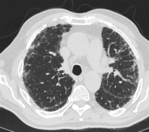 000 Reticular Pattern Reticulation The Common Vein 000 Reticular Pattern Reticulation The Common Vein