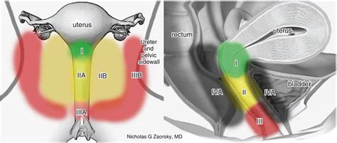Vulvar Cancer Staging
