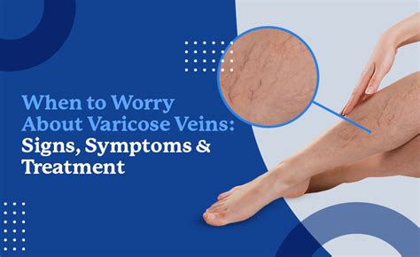 When To Worry About Varicose Veins Symptoms And Treatment