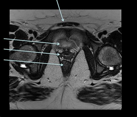 Diagramme de Abdomen Pelvis diapo 48 à 51 IRM du pelvis coupe axiale