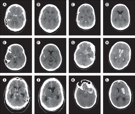 Traumatic Subarachnoid Hemorrhage
