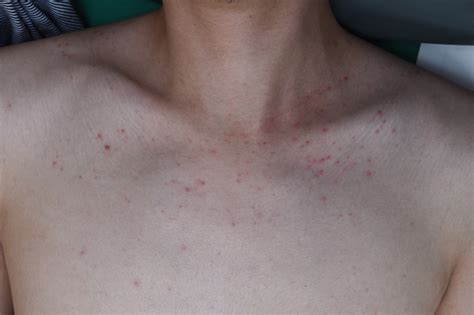 Pityrosporum Folliculitis Chest