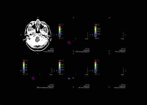 Brain Perfusion Right Occlusion Volume Aice