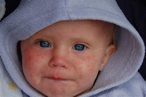 La Rougeole Une Maladie Mortelle Contre Laquelle La Vaccination Est