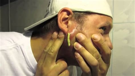 New Zit Popping Videos 2025 Robby Christie
