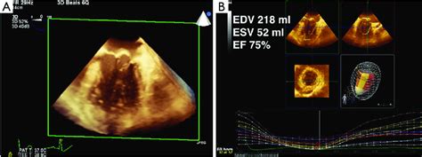 3d quantification of the left ventricle lv a multi beat 3d