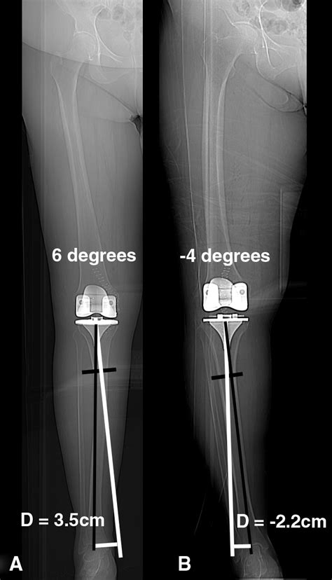 The Anatomic Axis Of The Tibia Longitudinal White Line Was A Line Download Scientific Diagram