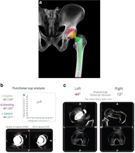 Measurements Made On Ct Imaging A Cup And Stem Positioning And