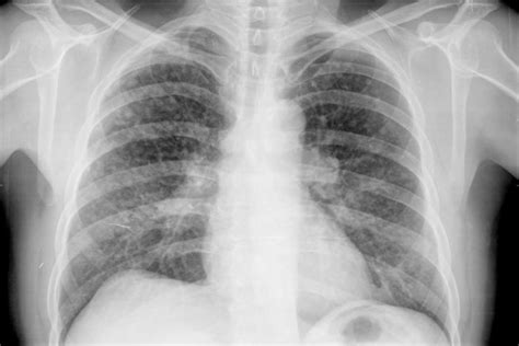 Archivosilicosis 1 Pneumowiki Enciclopedia De Neumología Y