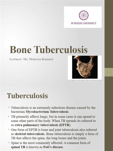 Bone Tuberculosis Download Free Pdf Tuberculosis Medicine