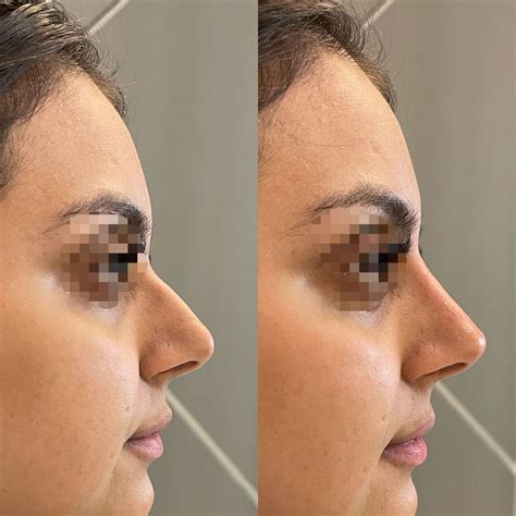 Injections And Fillers The Grand Medical Aesthetic Clinic