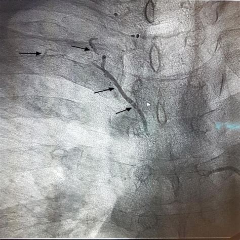 Post Embolization Image Glue Nbca Cast Formation Within The Right