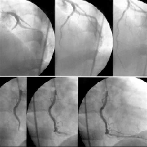 Dipyridamole 99m Tc Tetrophosmin Myocardial Perfusion Scintigraphy