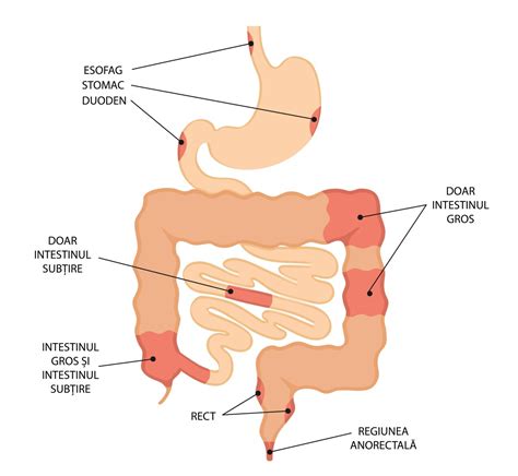 Boala Crohn nu se vindecă dar poate fi ținută sub control Iată cum