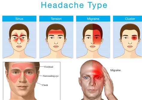 What Is Sinus Headache And The Cause Symptoms And Cure Of Sinus Headache