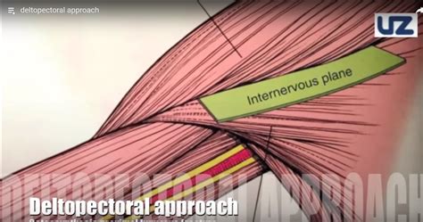 The Deltopectoral Approach Demonstration —