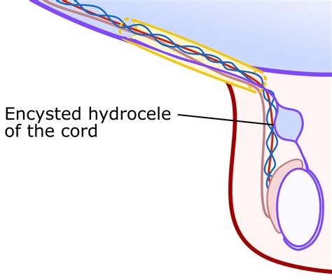 Hydrocele Scrotal Lump Geeky Medics