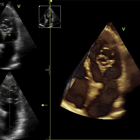 Three Dimensional Transthoracic Echocardiographic Imaging Displaying