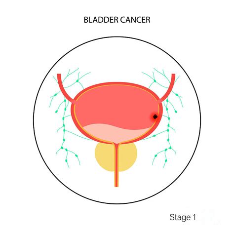 Bladder Cancer Stages 13 By Science Photo Library