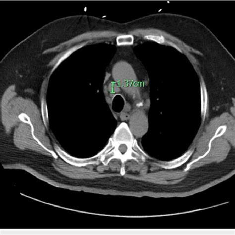 Ct Chest Without Contrast Axial View Showed The Enlarged Right