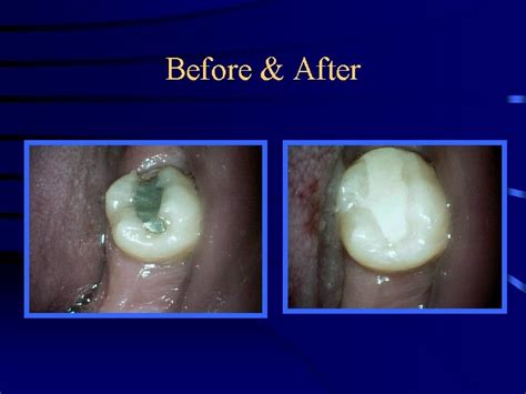 Esthetic Restorations For Posterior Teeth Bleaching Tooth Colored