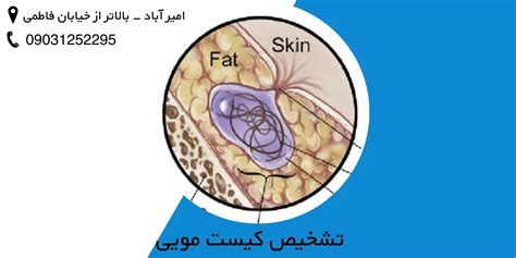 نحوه تشخیص کیست مویی از روی علائم