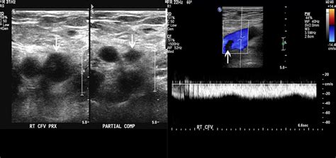 Trombose Venosa Profunda Doenças Cardiovasculares Manuais Msd
