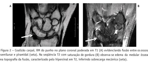 Dr Rinaldi Acupuntura SINDROME DO TÚNEL DO CARPO E ACUPUNTURA