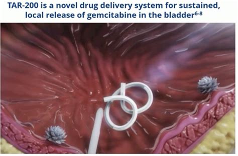 Esmo 2023 Sunrise 1 Tar 200 Monotherapy In Patients With Bcg Unresponsive High Risk Non Muscle