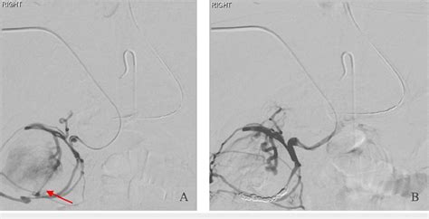 Percutaneous Transhepatic Embolization Of The Bleeding Colic Vein The
