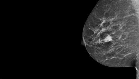 Breast Microbiome Profiles Linked To Higheror LowerChance Of Cancer