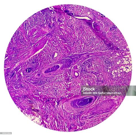 Photo Libre De Droit De Cancer De La Peau Biopsie Cutanée Sous