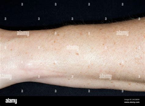 Forearm Of An Adult Female Patient Showing Tendon Inflammation From Tenosynovitis
